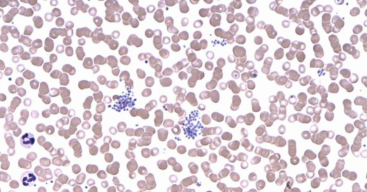 Blood Plasma Extracellular Vesicles Provide Window Into Cerebral ...