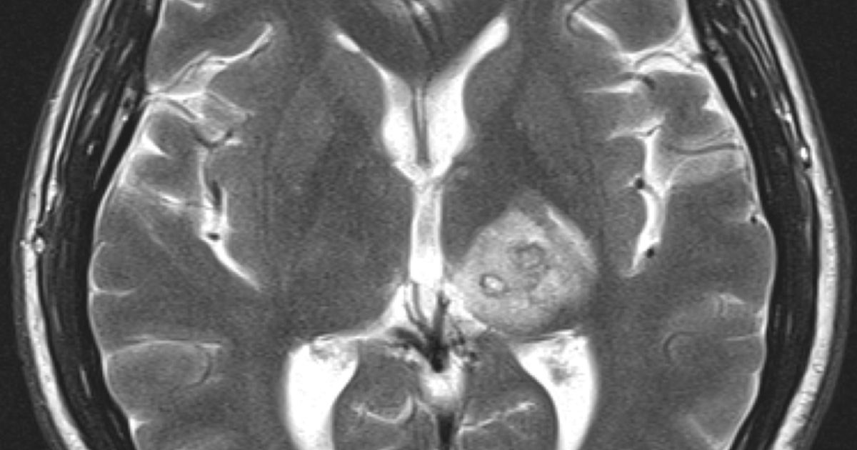 Sanger-led Team Sequences Patient's Brain Tapeworm | GenomeWeb
