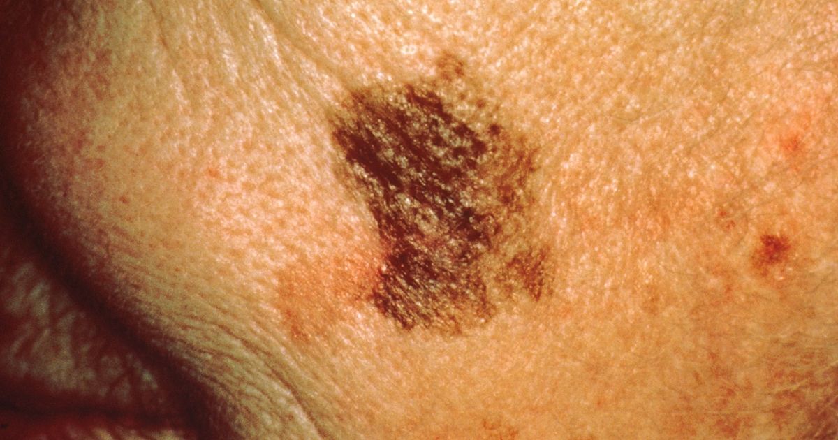 DermTech Emphasizes Opportunity of PLA Tech to Lower Cost of Melanoma ...