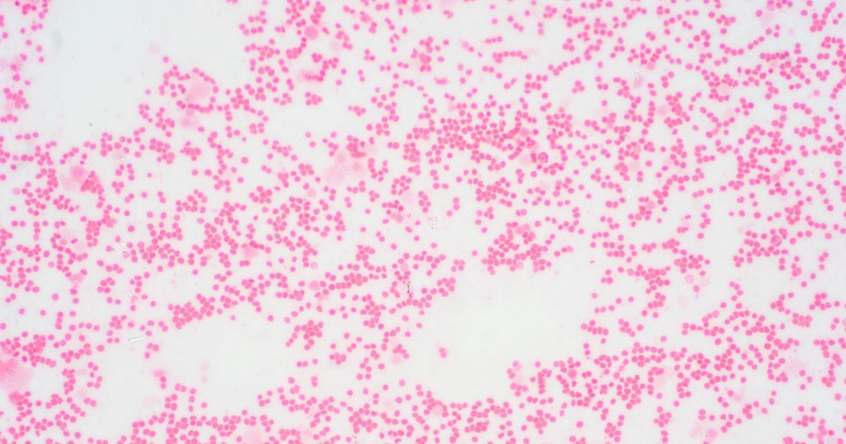 Myelodysplastic Syndrome Dx Trial Could Demonstrate Clinical Potential ...