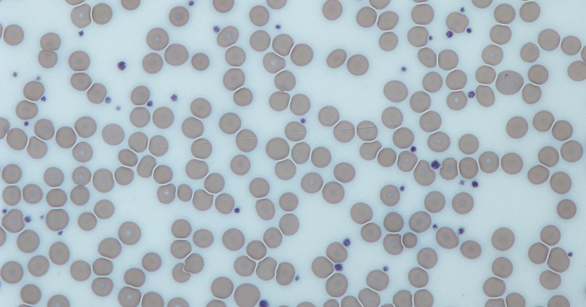 Study Affirms Platelet RNA's Diagnostic Potential for Early- and Late ...